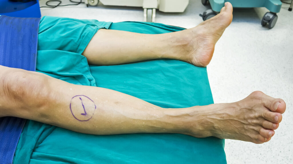 Is bunion surgery a big deal?