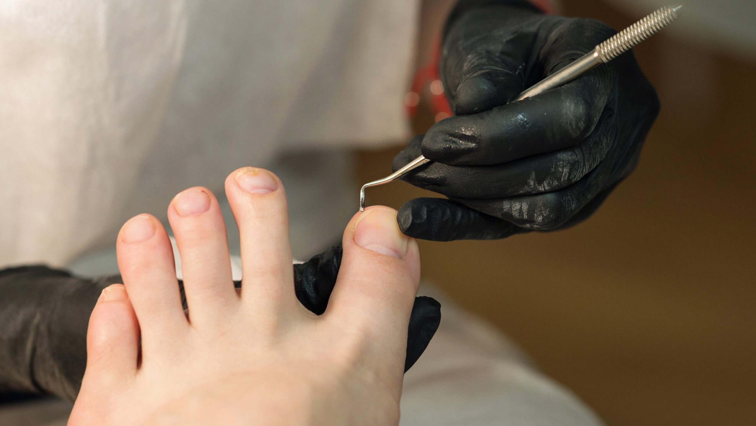 Can Diabetes Worsen Ingrown Toenail Problems? | Vital Podiatry Cypress ...